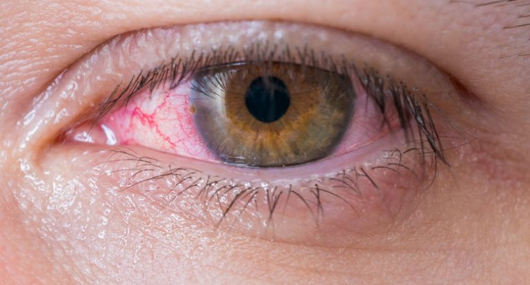 Cuidado con la Conjuntivitis viral - Clínica FOSCAL